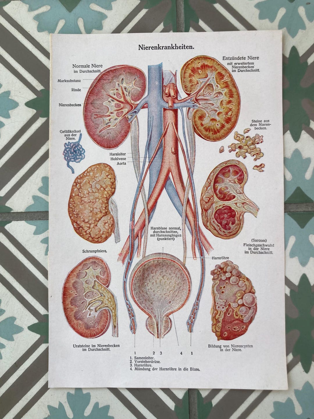 Kidney Diseases. Kidney. Organs. Diseases. Medicine. Antique Lithograph ...