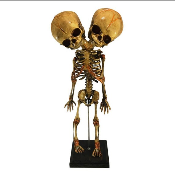 SIAMESE TWIN BABY Fetal Skeleton With Display Stand Statue. - Etsy