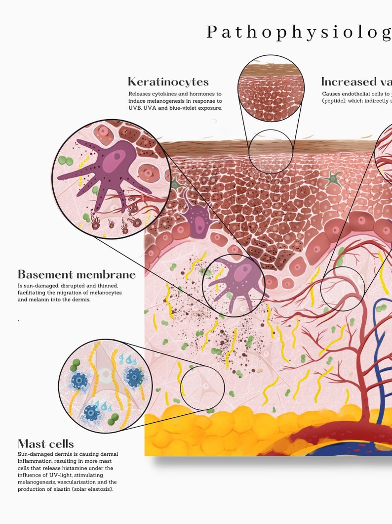 Melasma, Pathofysiolgy, Pigment, Huid Anatomie, Pigmentation, Anatomy ...