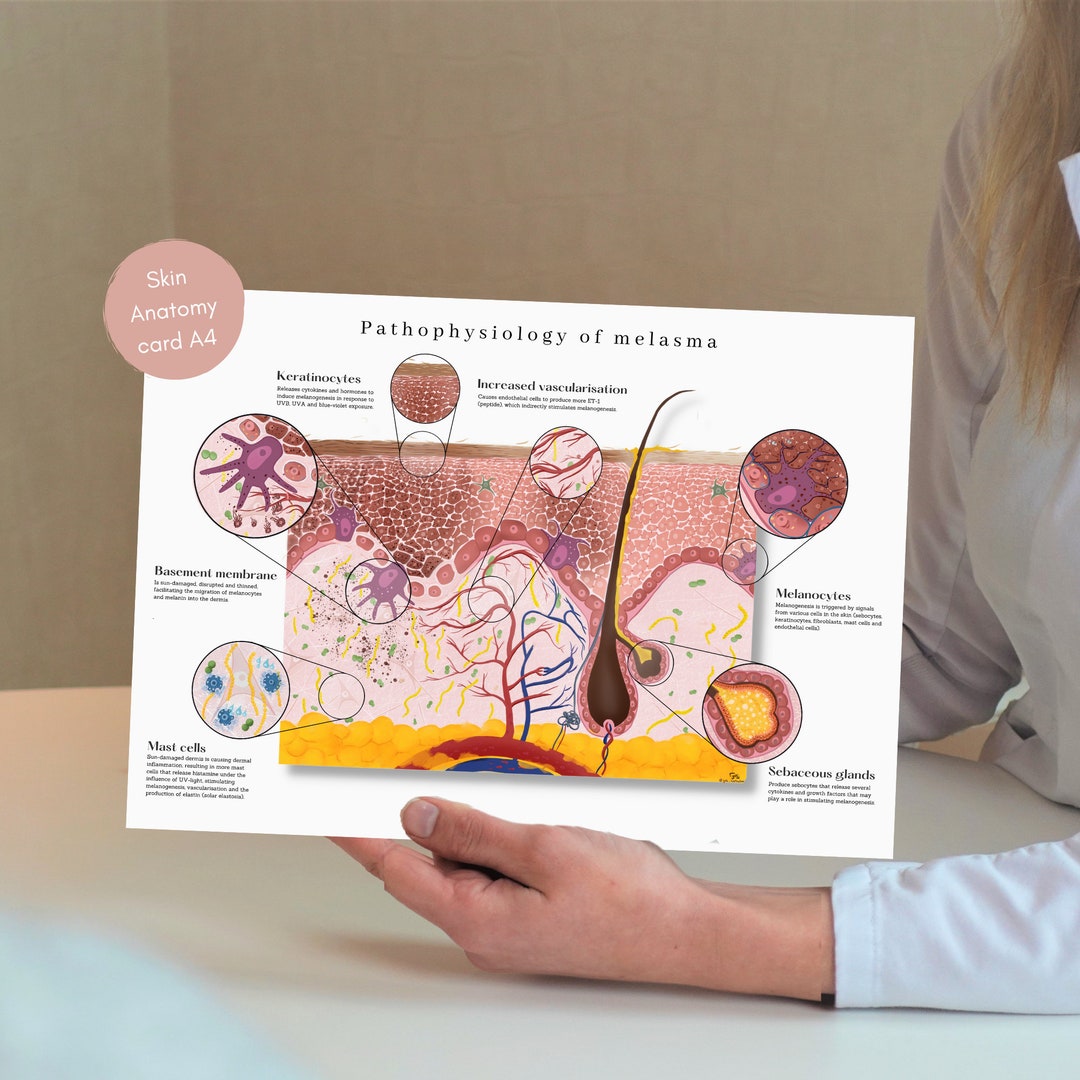 Melasma, Pathofysiolgy, Pigment, Huid Anatomie, Pigmentation, Anatomy ...