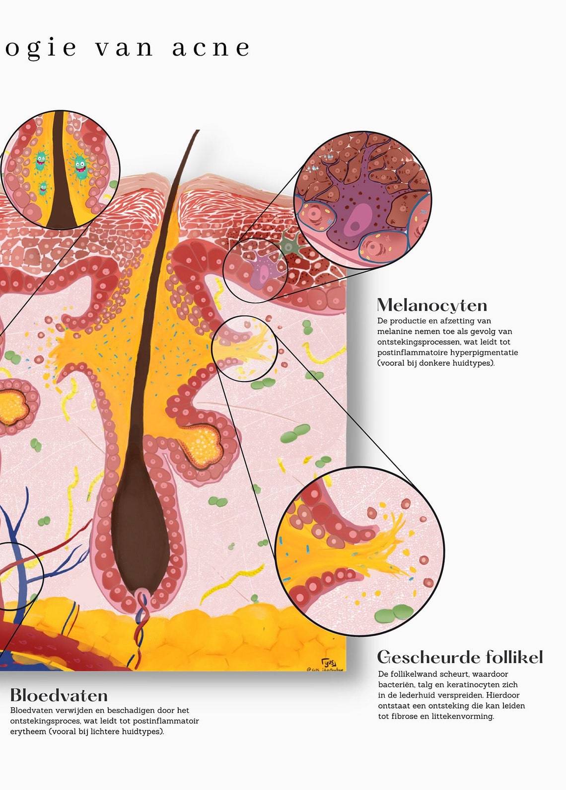 Acne Card, Acne Poster, Skin Anatomy, Skin Graphic, Anatomy Poster ...