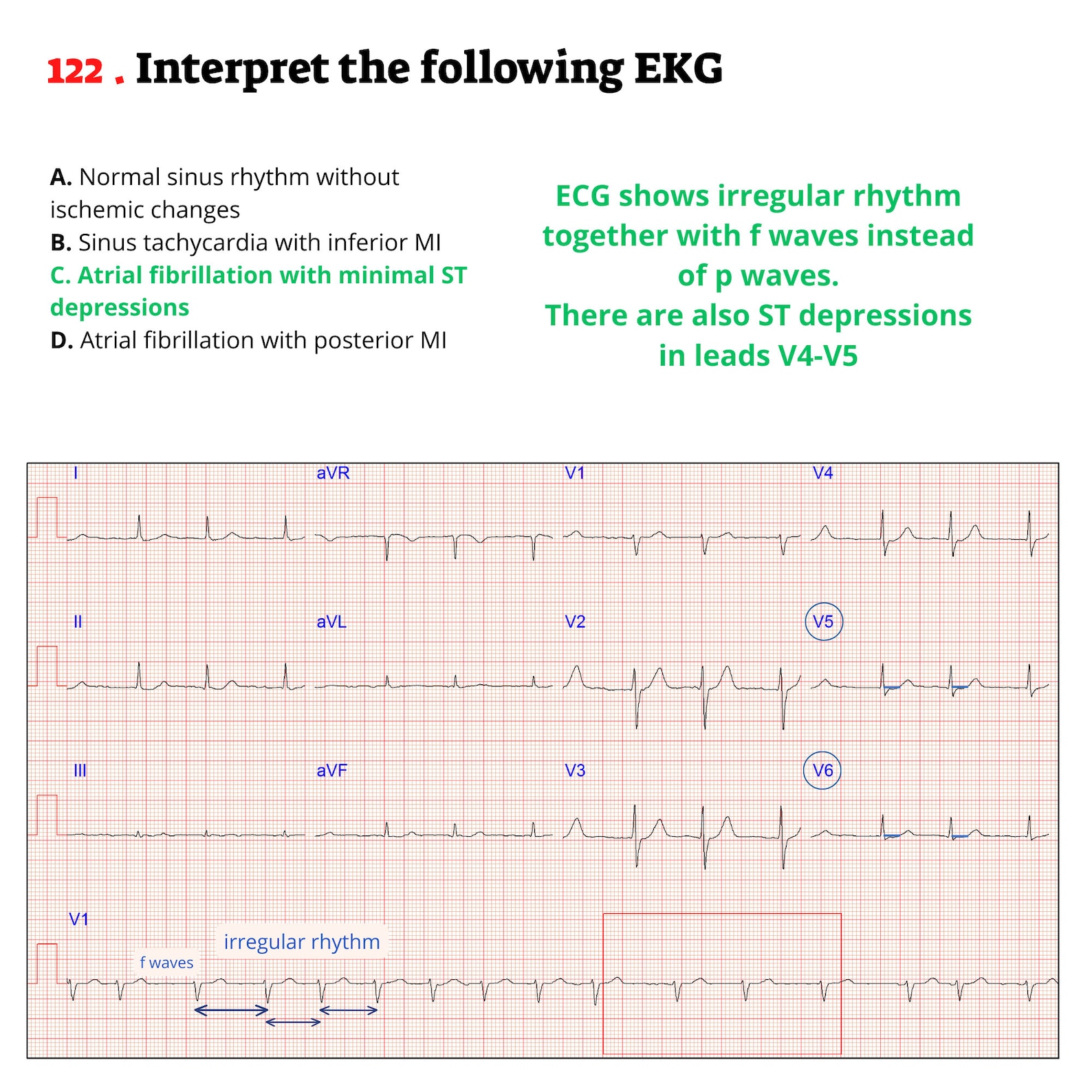 EKG Practice Test With Answers, EKG Practice Quiz, Quiz for Nursing ...