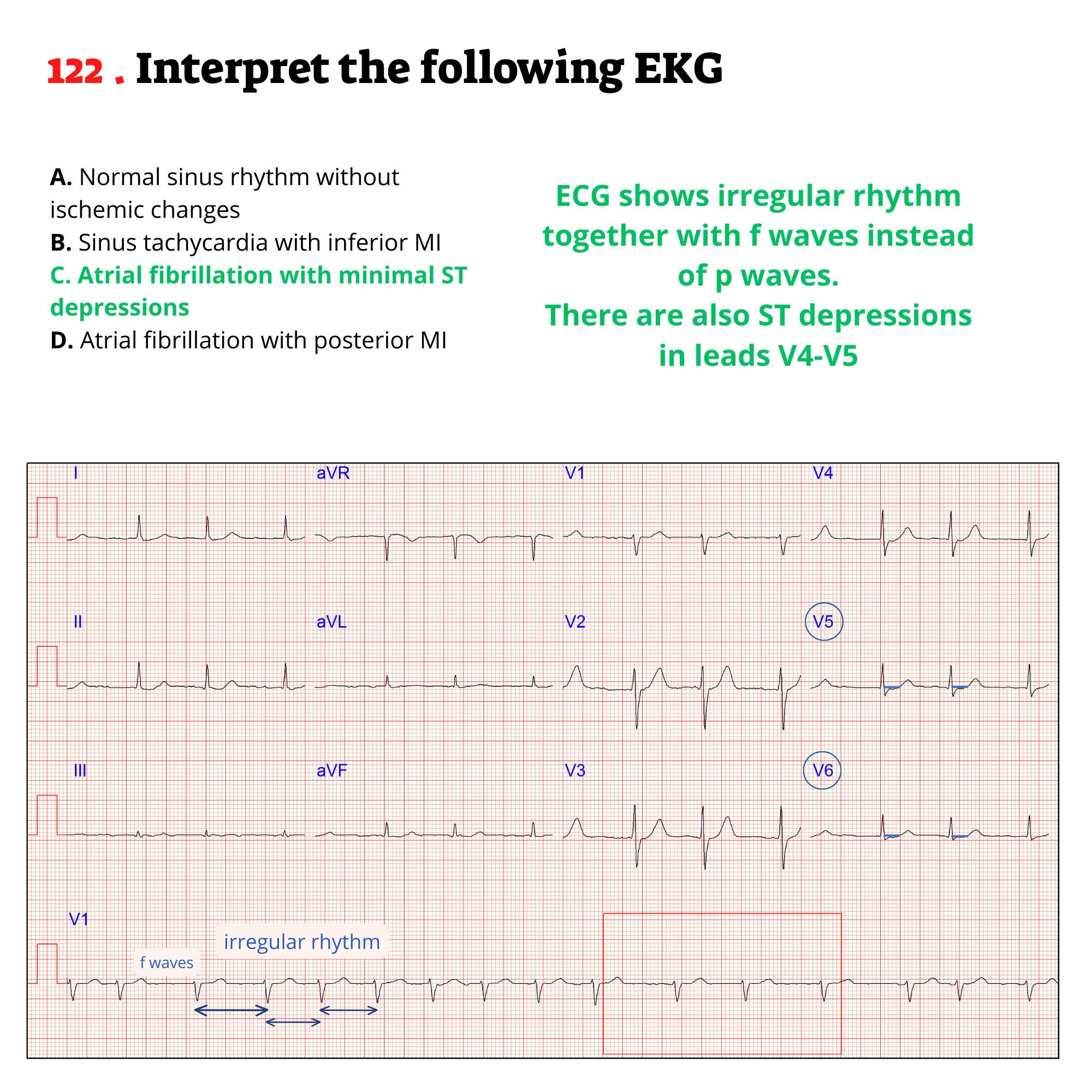 EKG Practice Test With Answers, EKG Practice Quiz, Quiz for Nursing ...