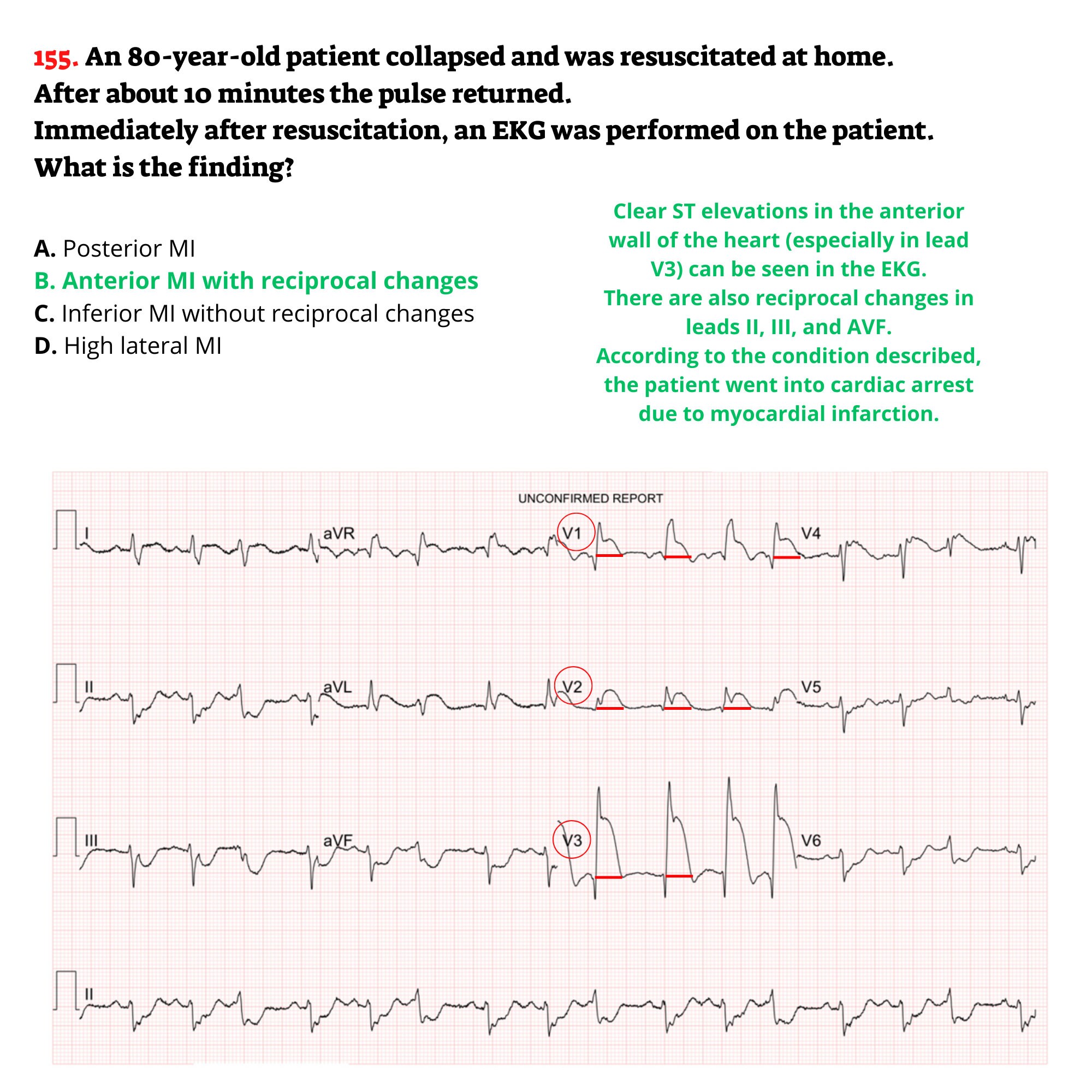 EKG Practice Test With Answers, EKG Practice Quiz, Quiz for Nursing ...