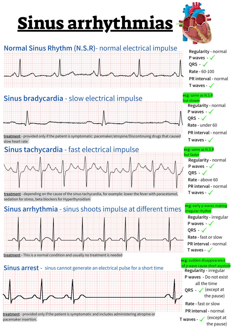 ECG Basics All Types of Ecg Arrhythmias Every Nurse and Nursing Student ...