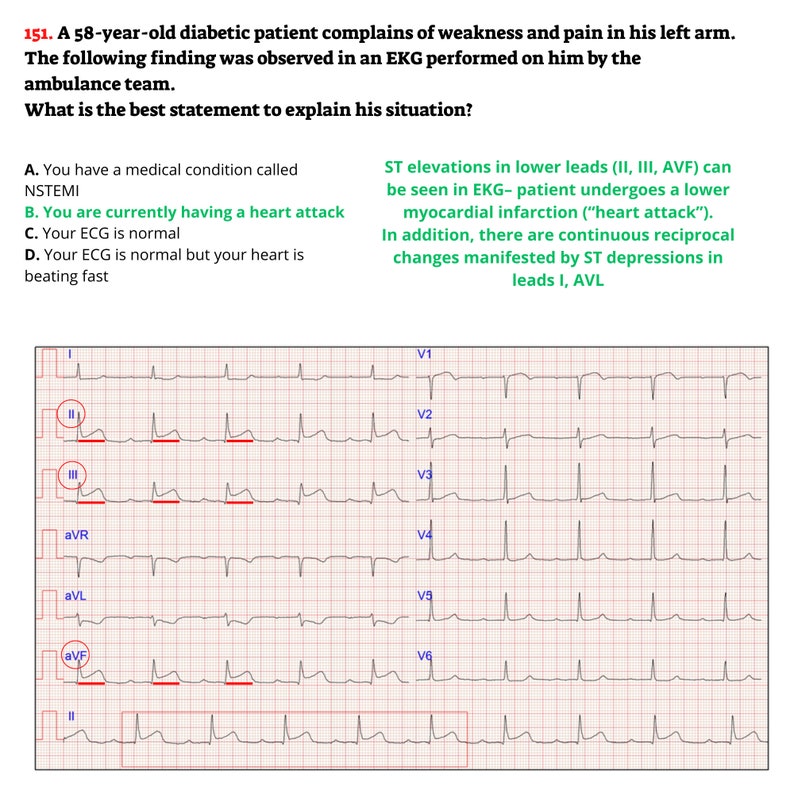 EKG Practice Test With Answers, EKG Practice Quiz, Quiz for Nursing ...
