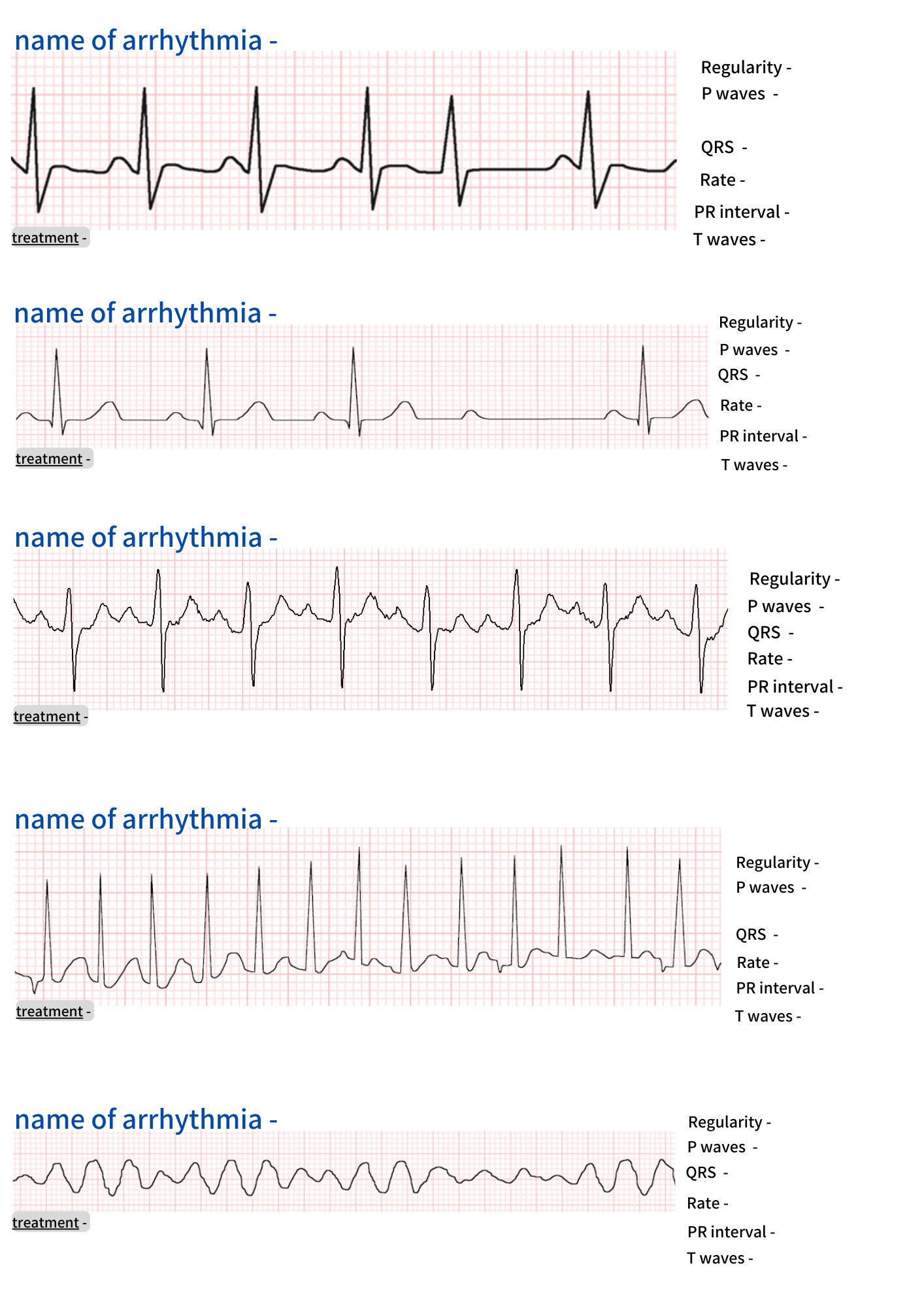 ECG Basics All Types of Ecg Arrhythmias Every Nurse and Nursing Student ...