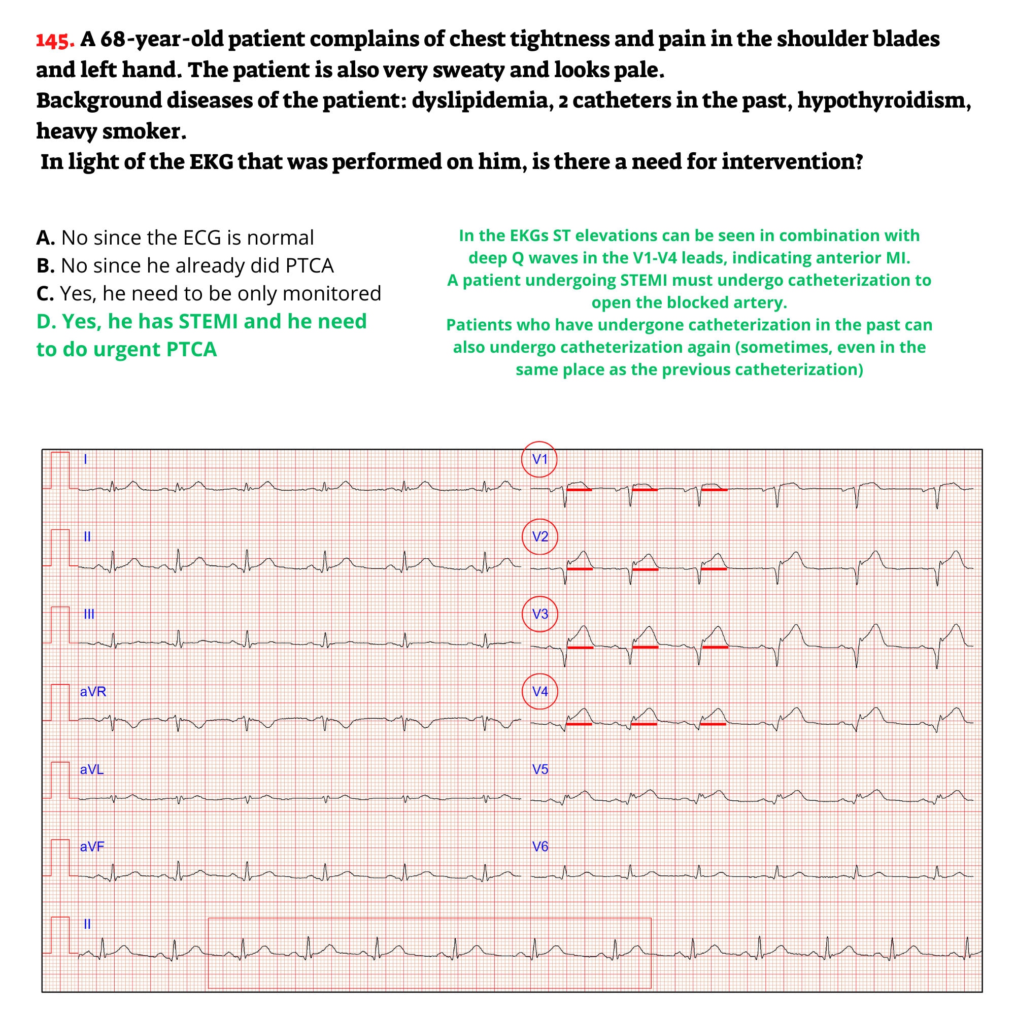 EKG Practice Test With Answers, EKG Practice Quiz, Quiz for Nursing ...