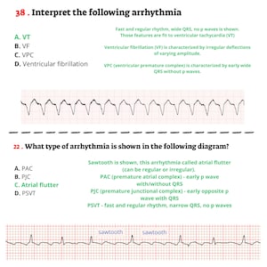 EKG Practice Test With Answers, EKG Practice Quiz, Quiz for Nursing ...