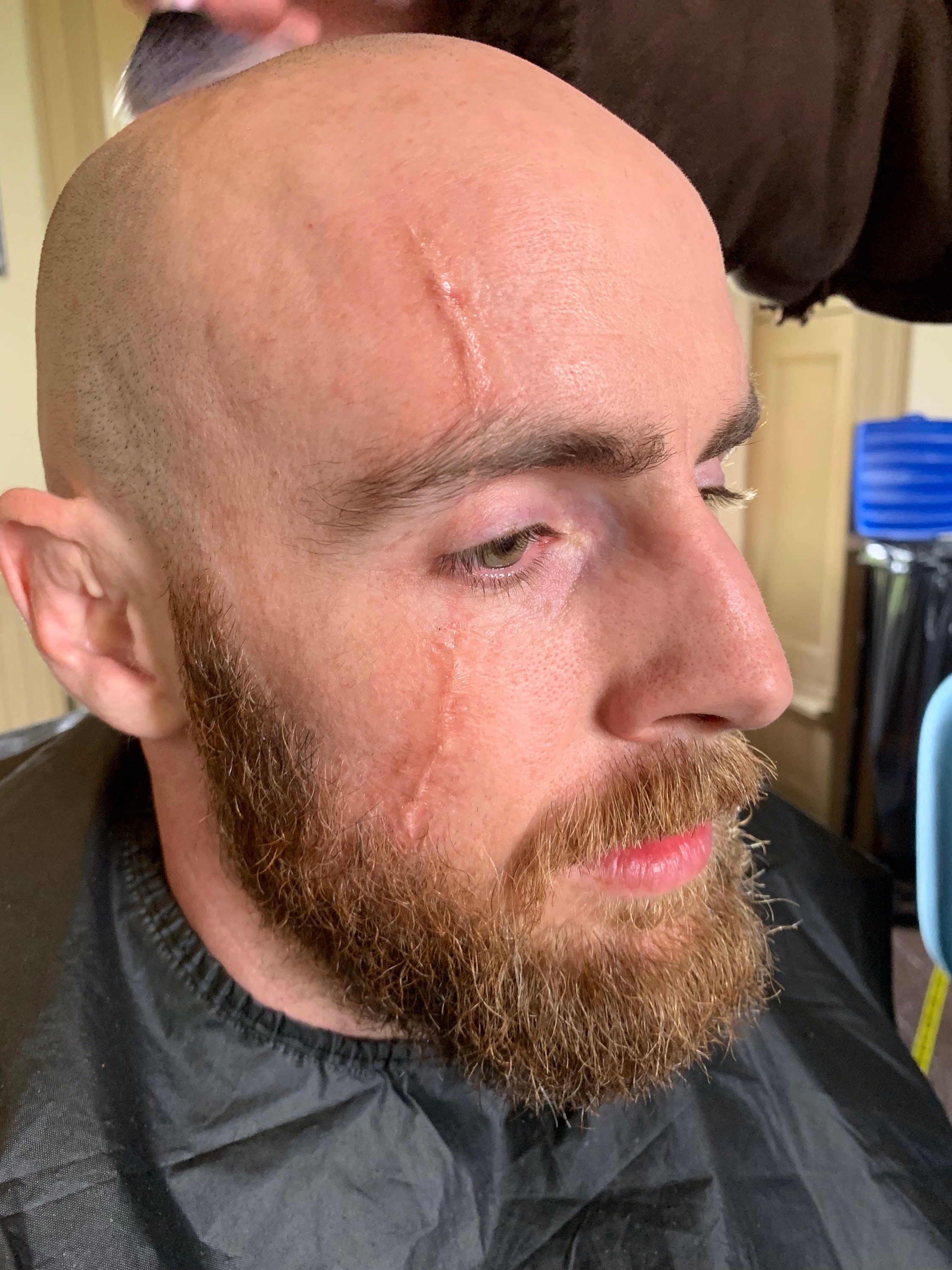 Eye Scar Silicone Prosthetic - Etsy