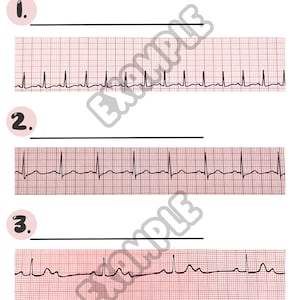 EKG Cheat Sheet: Rhythm Interpretation & Dysrhythmias (digital Download ...