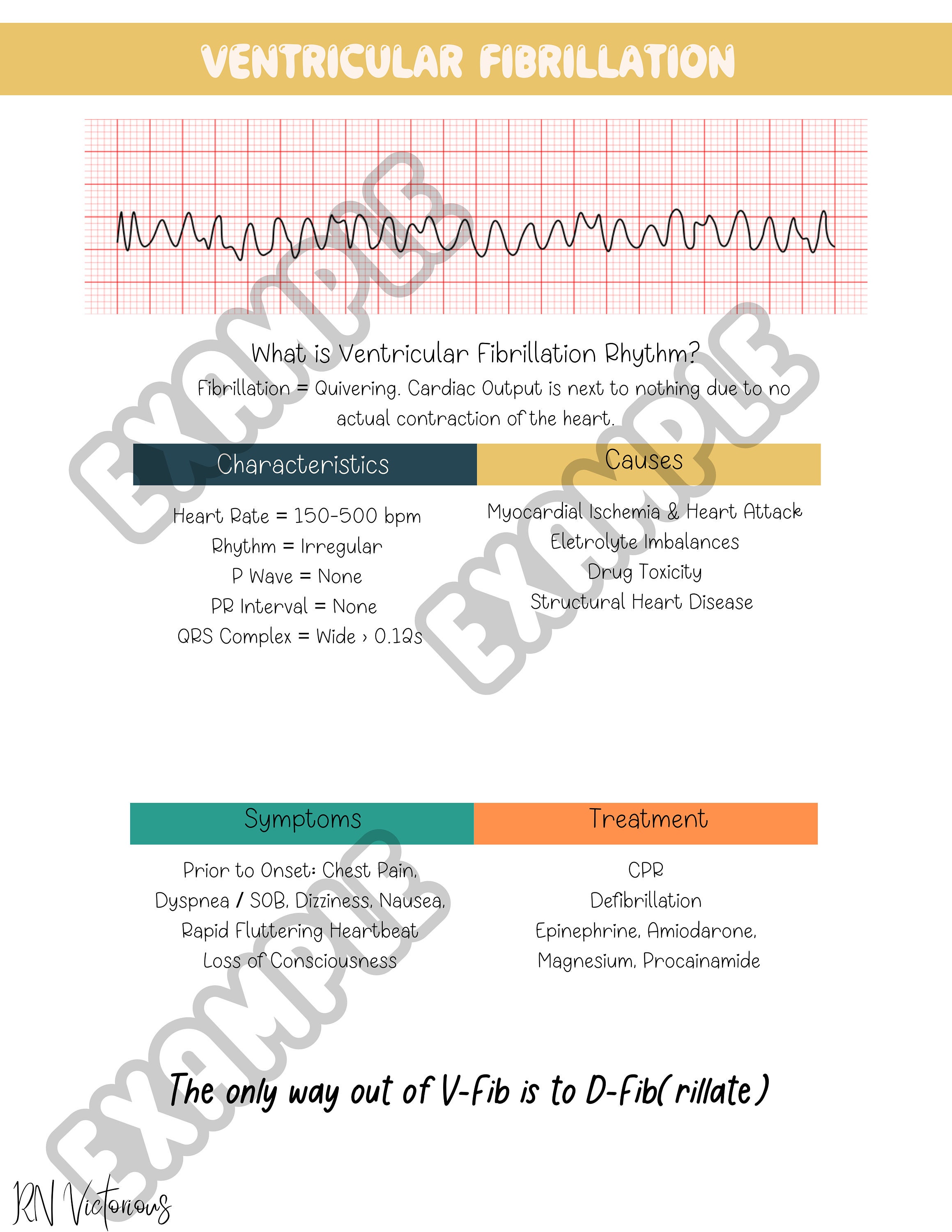 EKG Cheat Sheet: Rhythm Study Guide & Practice (PDF Download) - Etsy