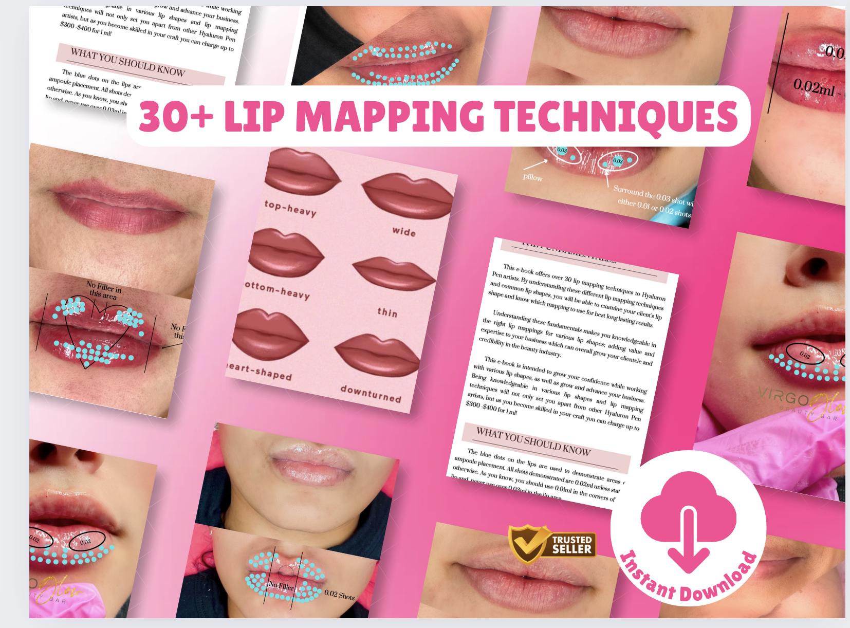 Hyaluron Pen Lip Mapping, Lip Filler Mapping, Russian Lip Technique ...