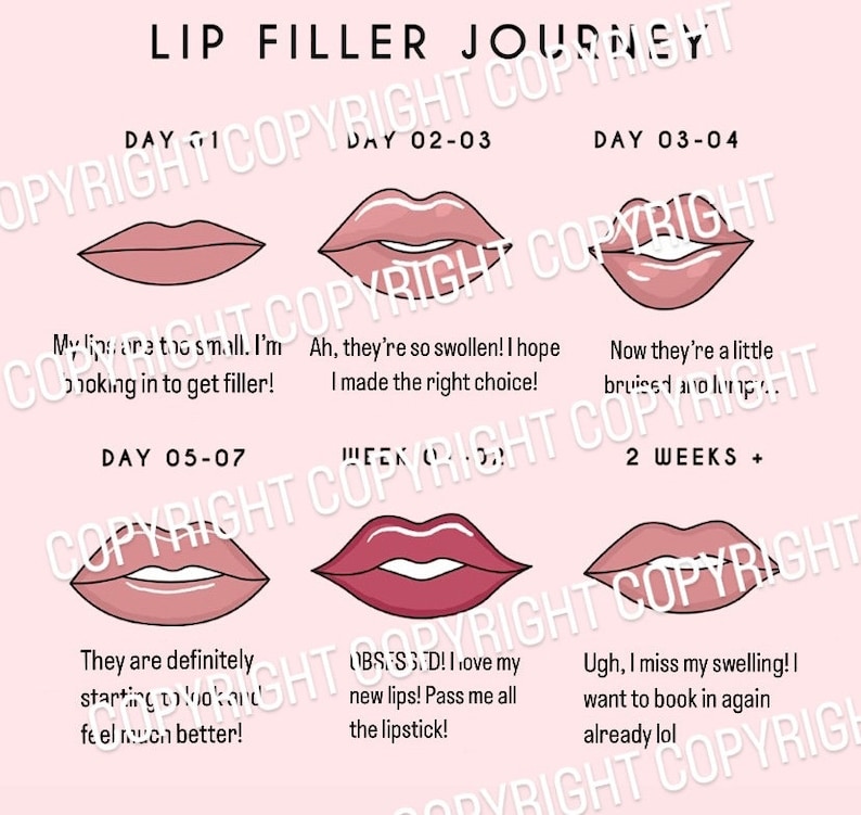Digital Download Lip Filler Aftercare Leaflet Template - Etsy