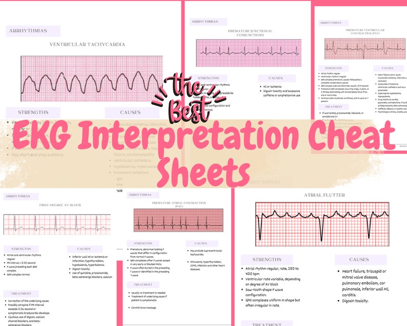 The Best EKG Interpretation & Heart Arrhythmias Cheat Sheet - Etsy