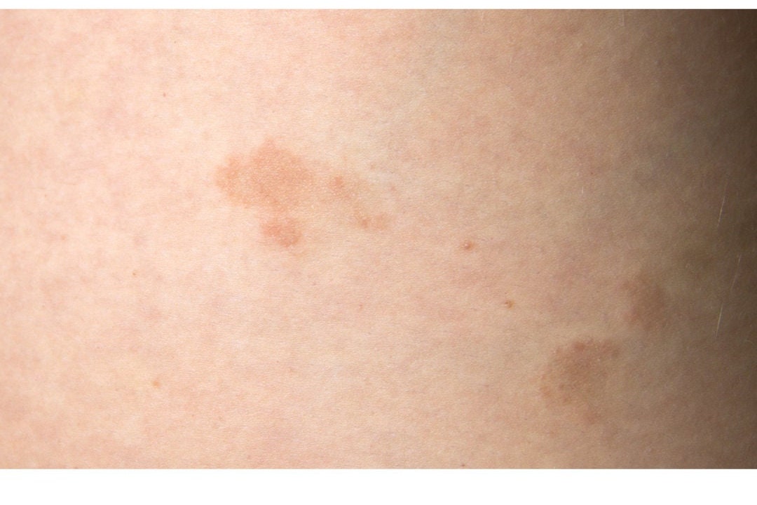 Pityriasis Rosea Relief Ebook, Itchy Dry Skin Rash Relief Ebook Pdf ...