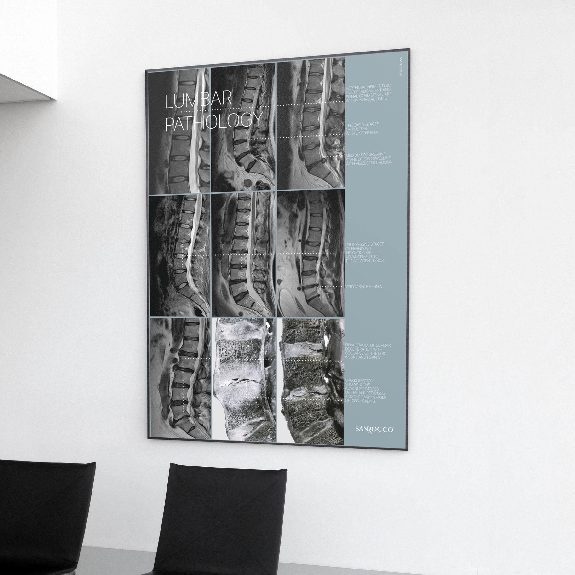 Lumbar Pathology. | Etsy