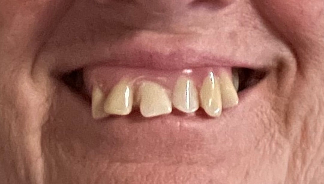 Custom Fitted Party Teeth Halloween False Teeth Theatre Teeth Pageant ...