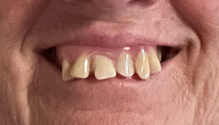 Custom Fitted Party Teeth Halloween False Teeth Theatre Teeth Pageant ...