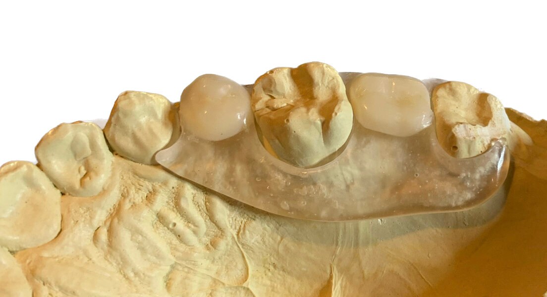 Flipper Nesbit Impression Kit Missing Tooth Space Filler Cosmetic ...