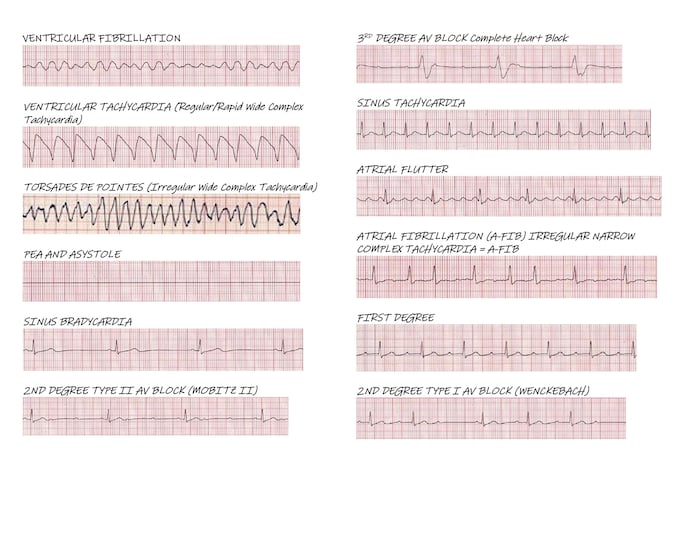 Cardiac Rhythm Examples - Etsy