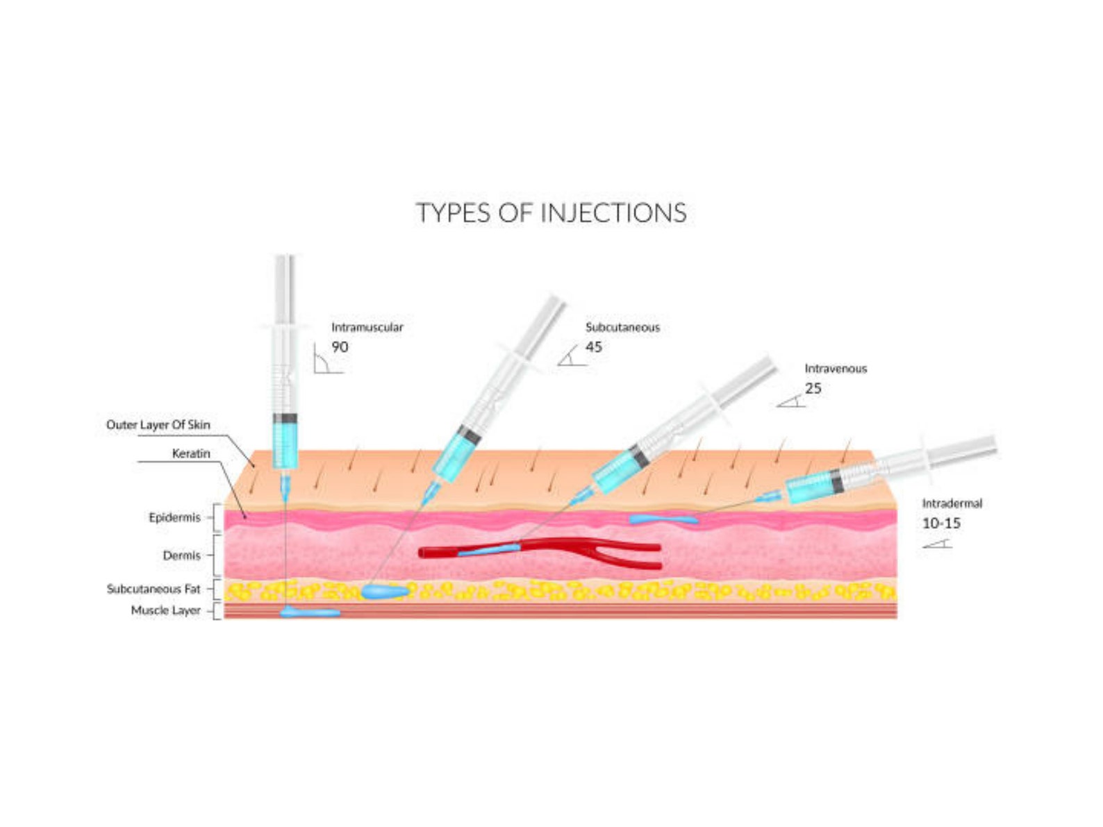 Different Types of Injections - Etsy