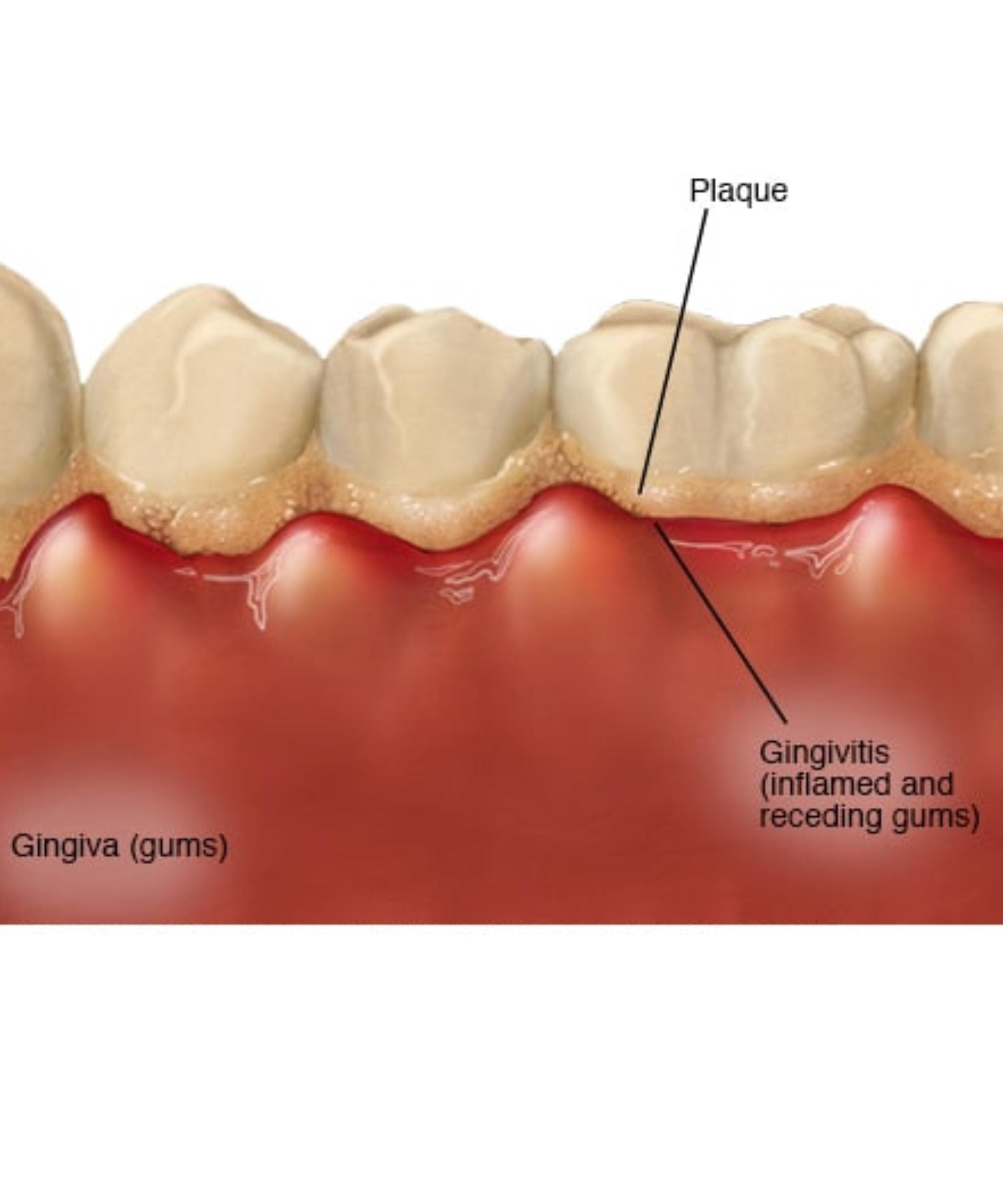 Gum Disease Chart Gingivitis Oral Disease Oral Healrh, Fight Gum ...