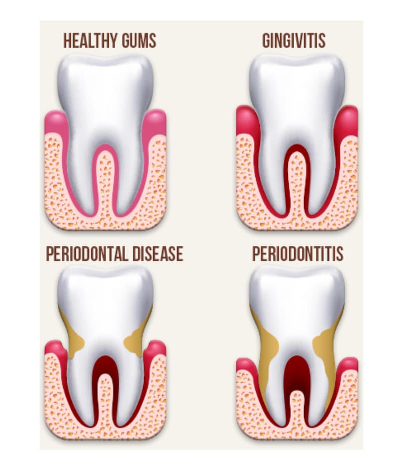 Gum Disease Chart, Oral Health Gingivitis Chart, Fight Gum Disease - Etsy