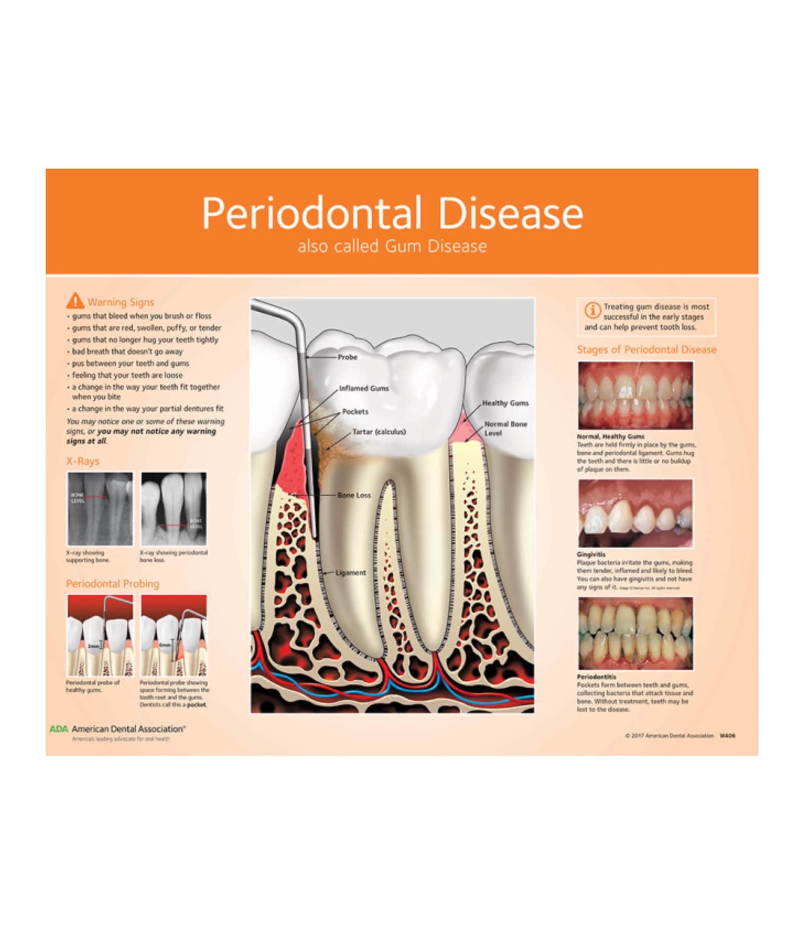 Periodontal Disease Chart, Oral Health Gingivitis Gum Disease - Etsy