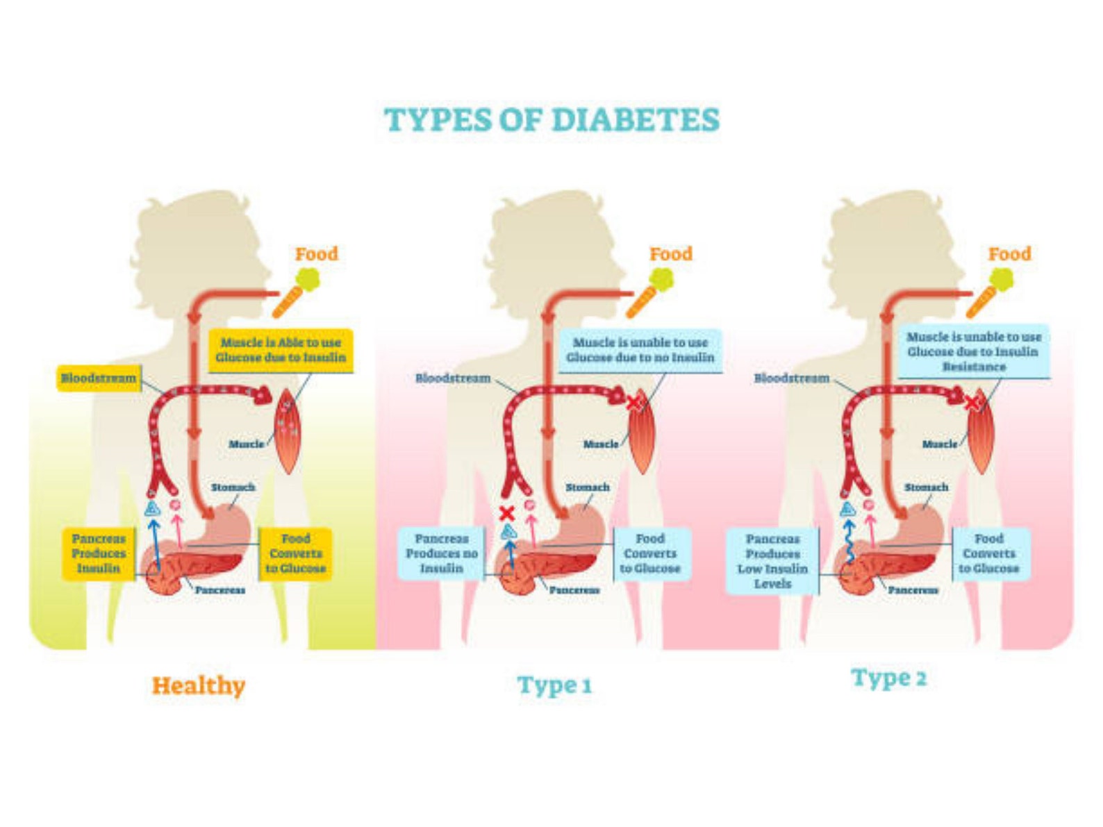 Types of Diabetes Chart - Etsy