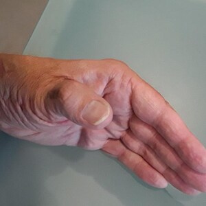 Thumb Splint Ring, MCP Hyperextension Splint Ring, Arthritis Rings ...