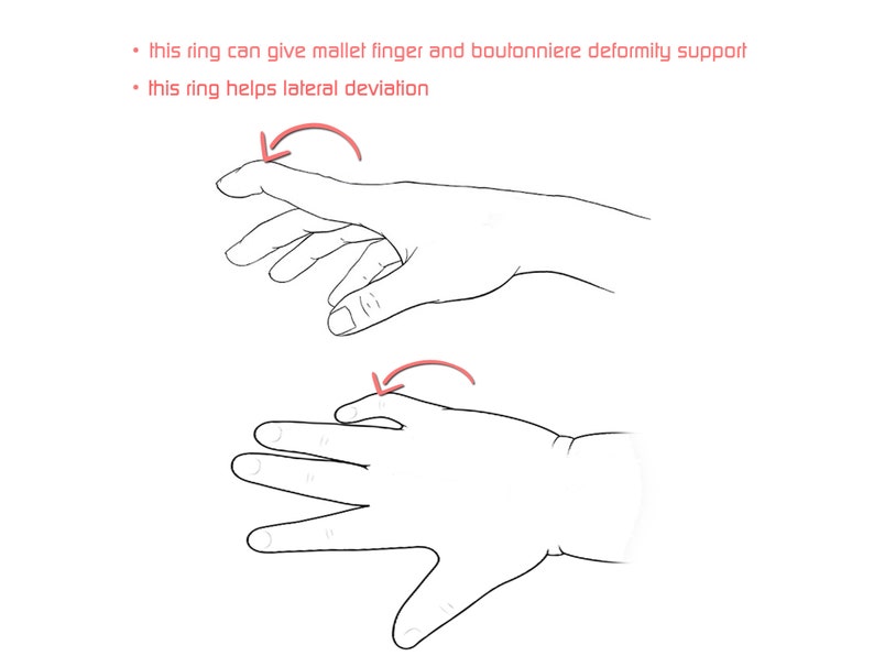 Arthritis Finger Splint for Radial or Ulnar Deviation - Etsy