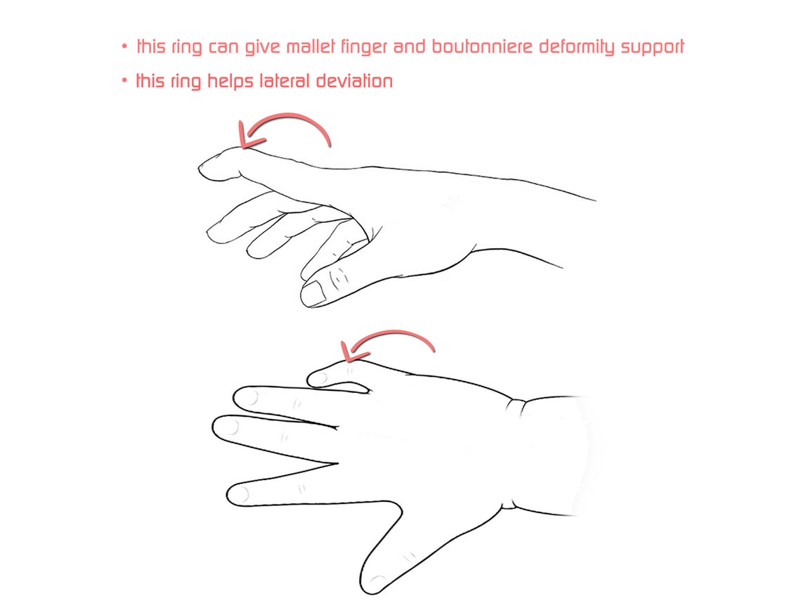 Arthritis Ring for Lateral Deviation Bending Sideways Finger - Etsy