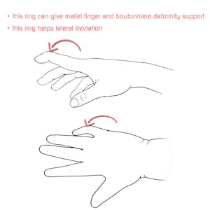 Arthritis Ring for Lateral Deviation, Bending Sideways Finger Splint ...
