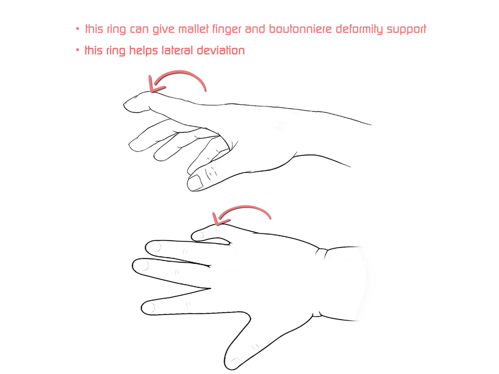 Mallet Finger Splint Lateral Deviation Aid Arthritis Finger - Etsy