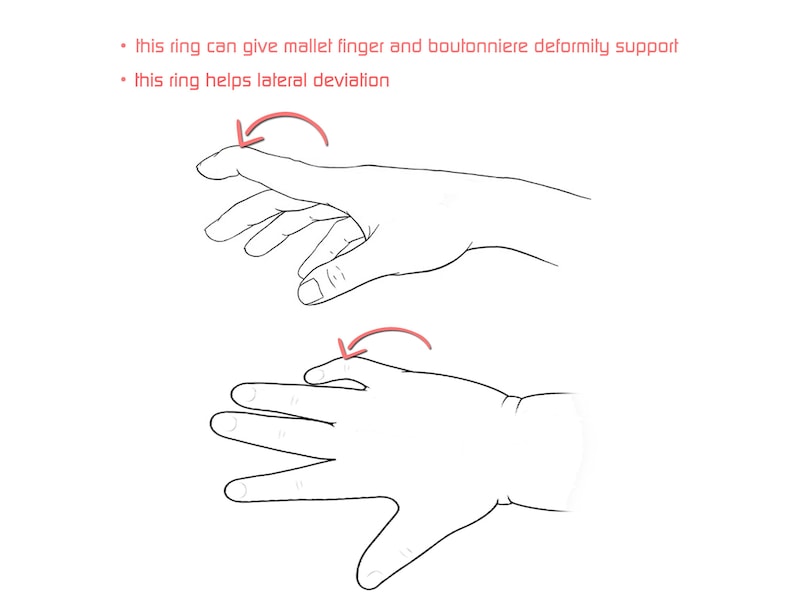 Lateral Deviation Pinky Finger Splint Ring, Arthritis Titanium, Brass ...