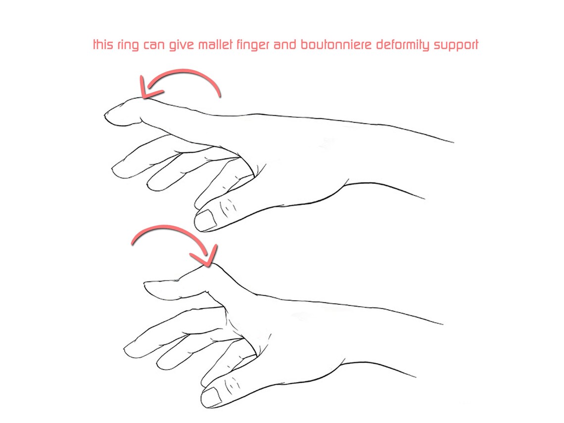 EDS Splint Ring DIP and PIP Joints Ring Arthritis Finger - Etsy