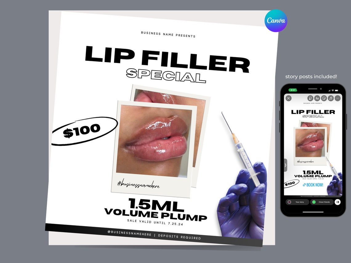 Lip Filler Special Flyer, Flyer for Lip Fillers, Esthetician Flyer ...
