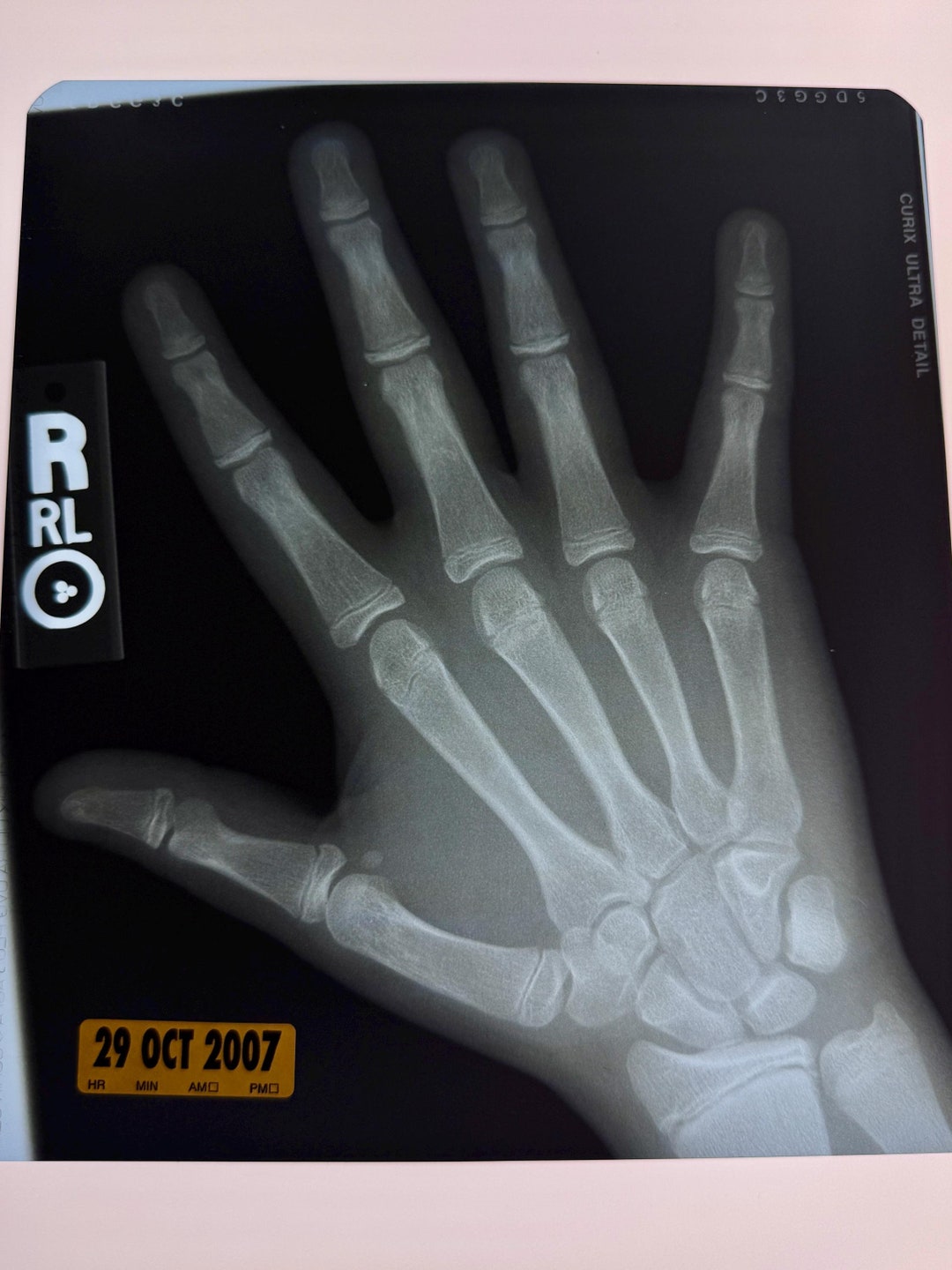 Real Human Hand X-ray Films Medical Education Curiosity Ephemera Curio ...