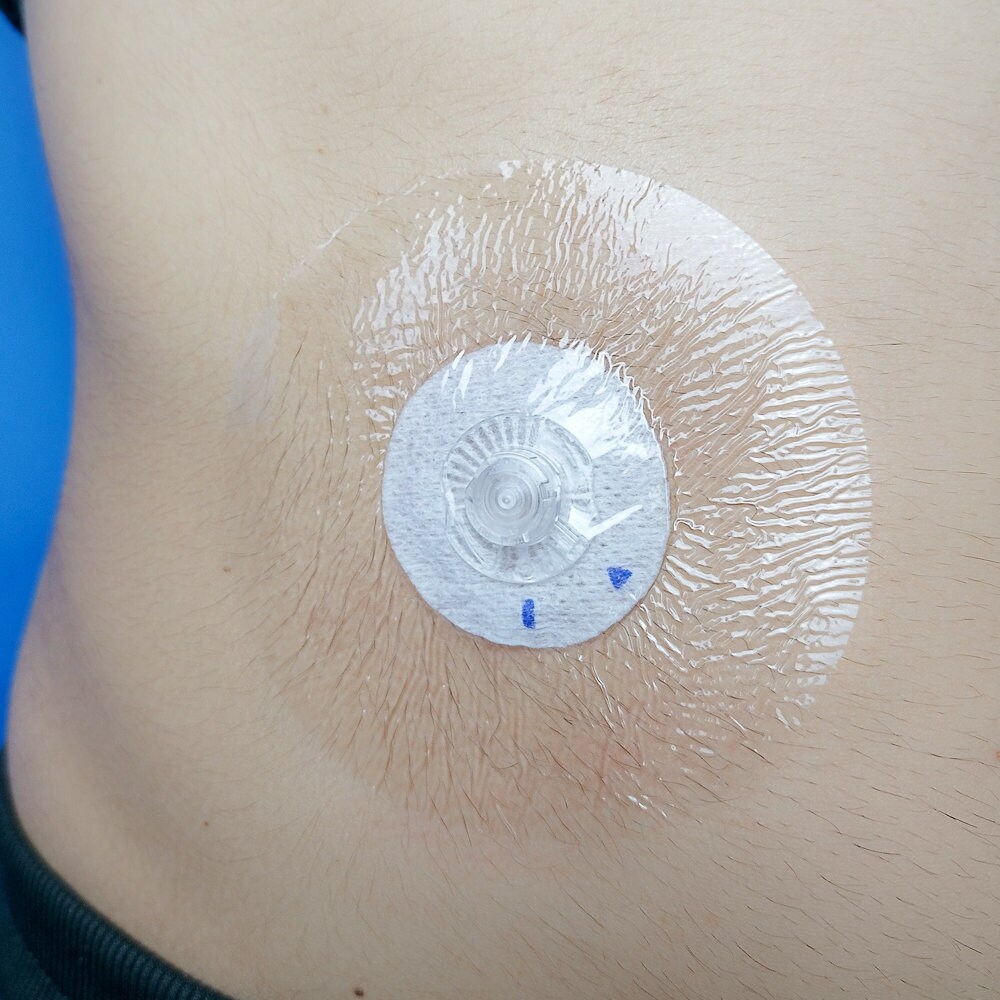Medtronic Infusion Set Protective Transparent Patches Diabetic Patches ...