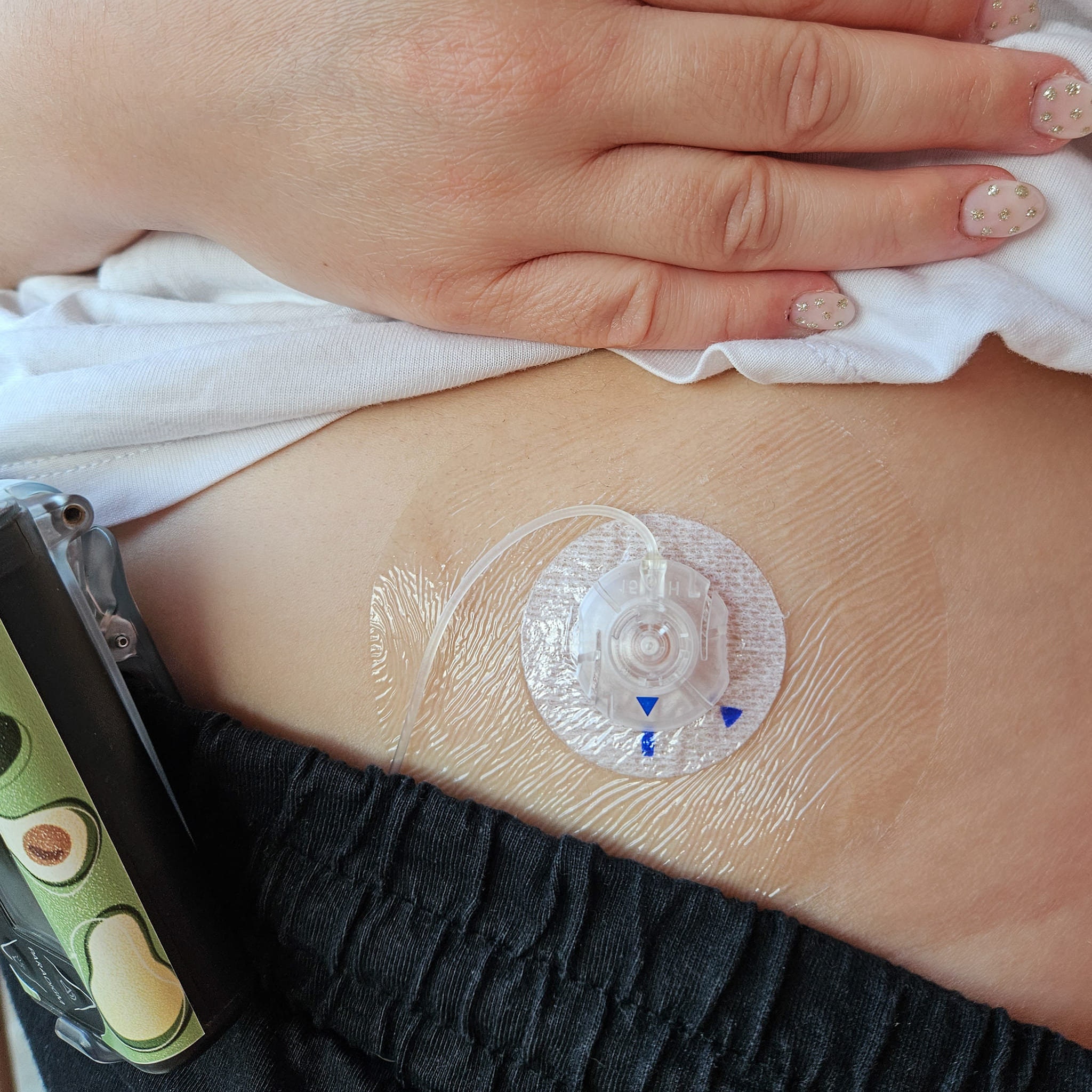 Medtronic Infusion Set Protective Transparent Patches Diabetic Patches ...