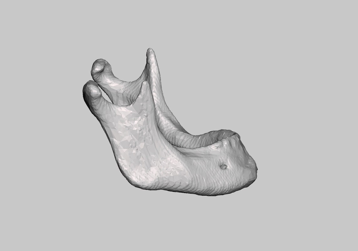 African American Male Skull and Jaw, AMAZINGLY Round (modern Human CT ...
