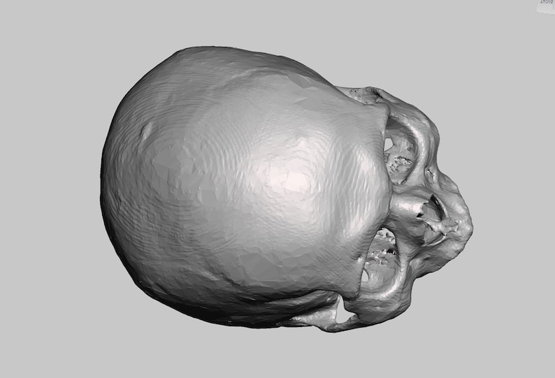 African American Male Skull and Jaw, AMAZINGLY Round (modern Human CT ...