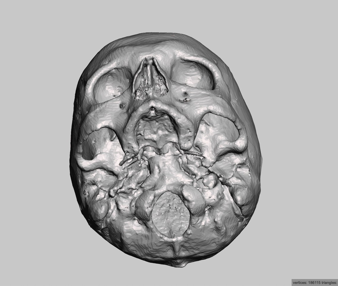 African American Male Skull and Jaw, AMAZINGLY Round (modern Human CT ...