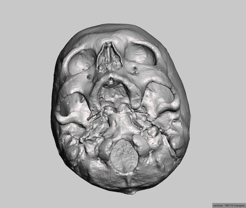 African American Male Skull and Jaw, AMAZINGLY Round (modern Human CT ...