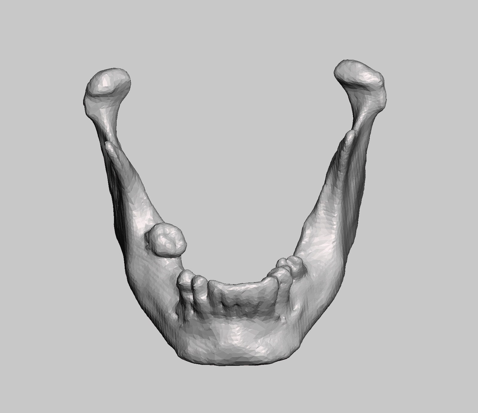 African American Male Skull and Jaw, LARGE Inion Hook (modern Human CT ...