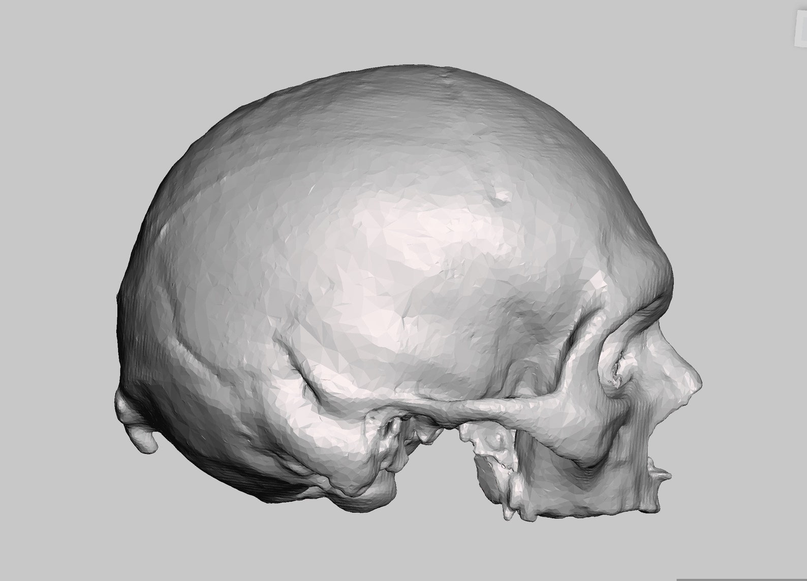 African American Male Skull and Jaw, LARGE Inion Hook (modern Human CT ...