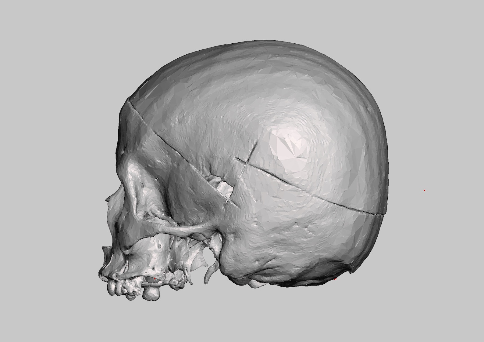 Female Undetermined Ancestry Skull, Autopsied (modern Human CT SCAN ...