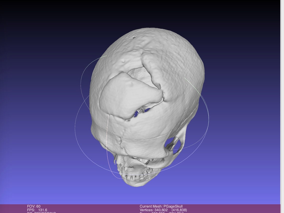 Phineas Gage Skull, harvard CT SCAN, Museum Quality High Resolution STL ...