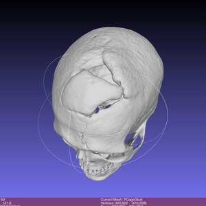 Phineas Gage Skull, (harvard CT SCAN), Museum Quality High Resolution ...
